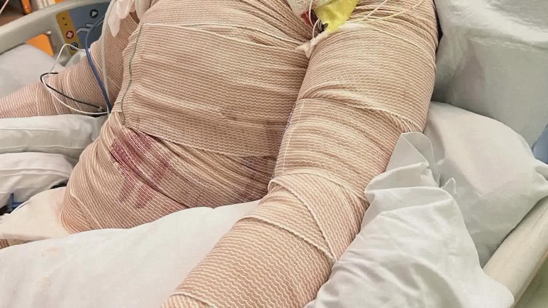 Cooking oil spill leaves Texas boy with burns on 85% of his body ...