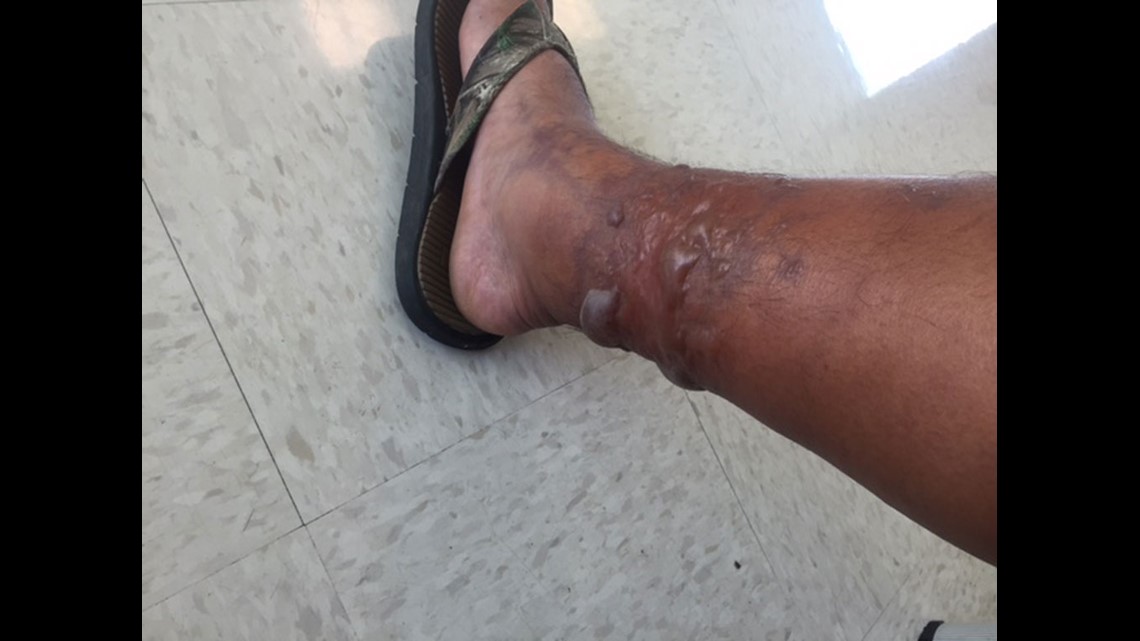 Verify Will I Contract Flesh Eating Bacteria At The Beach In Texas
